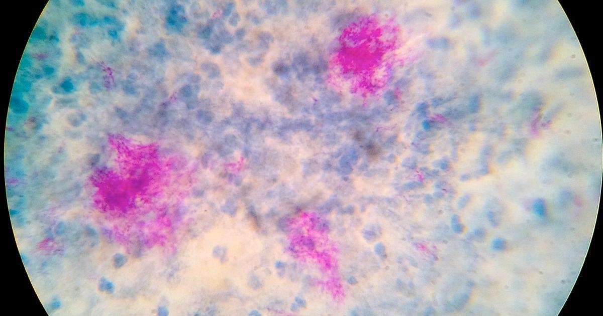 Acid-fast Staining (Ziehl-Neelsen, Kinyoun) And Interpretation | Sean ...